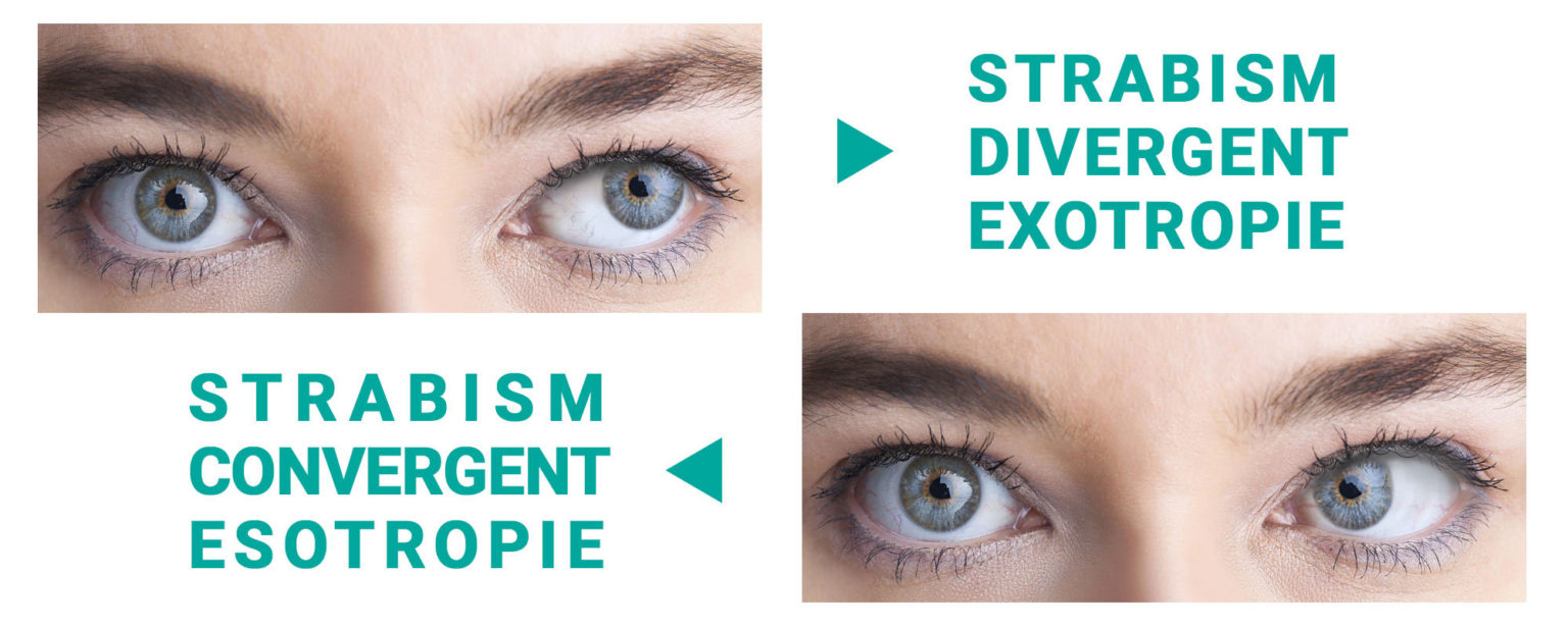 Strabismul la Adult - Dr. Gabriela Birlea, Chirurg Oftalmolog • ProVisual